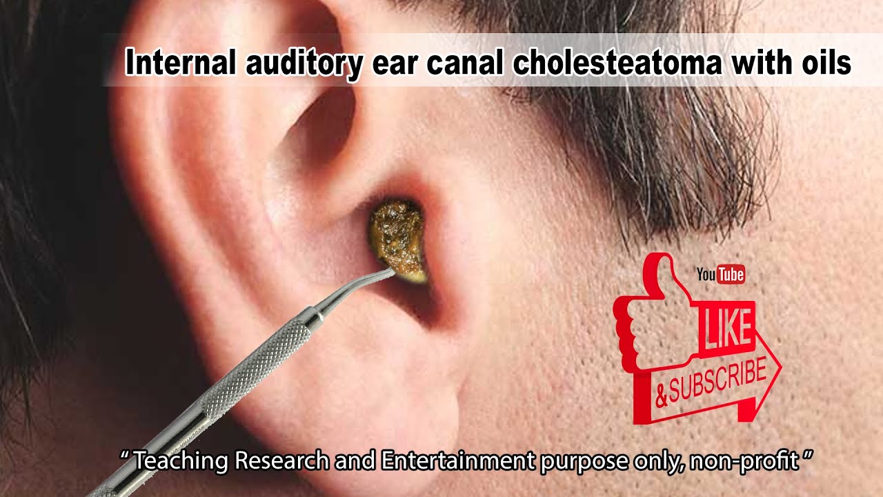 Internal audiology ear canal cholesteatoma with oils - YouTube