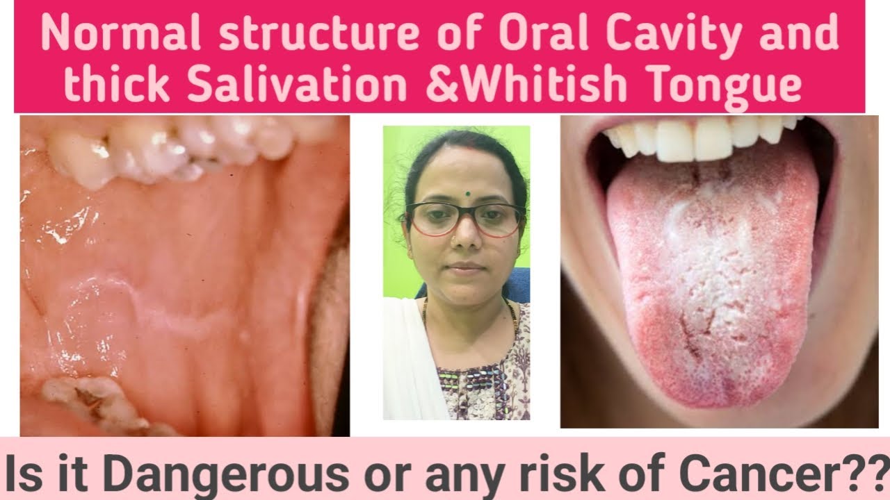 Normal structure of Oral Cavity, Tongue whitish in colour & thick ...