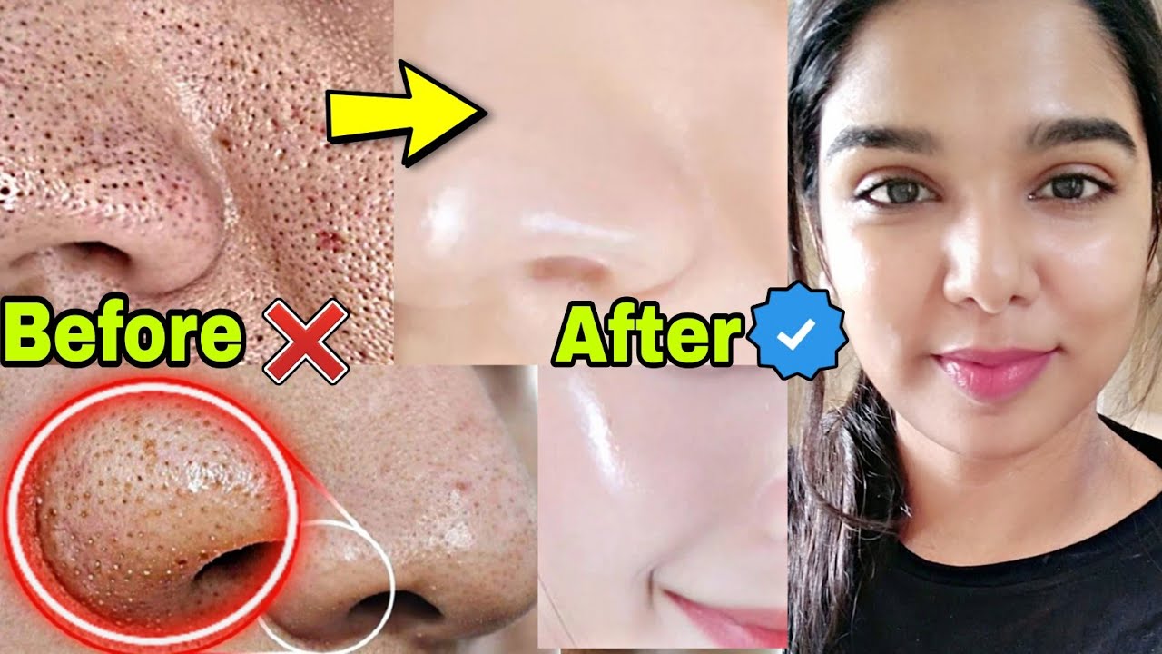 🔥JUST in 2 USES Remove Clogged Pores, Blackheads, Bumps, Whiteheads ...