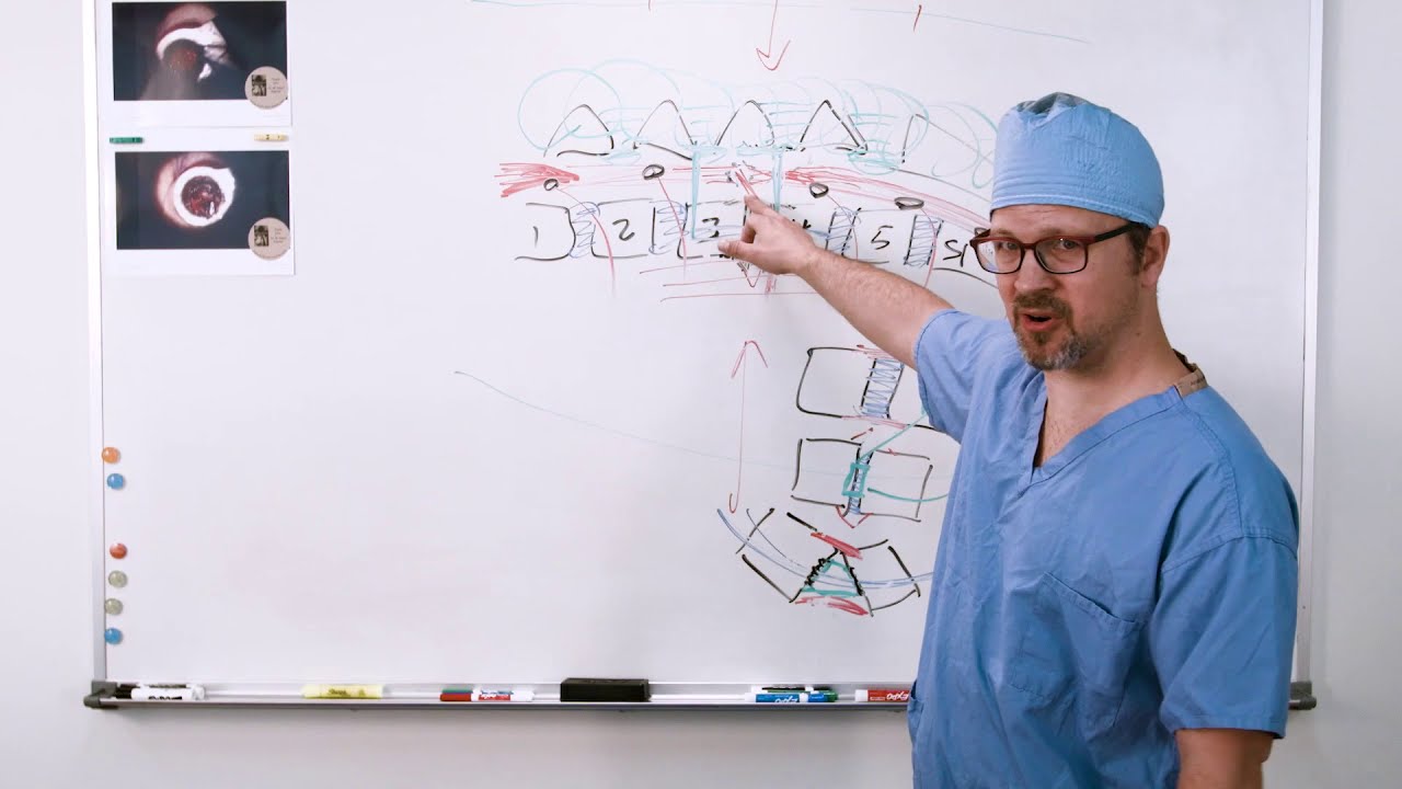 Pain Management | Post Operation | MIS-TLIF Transforaminal Lumbar ...