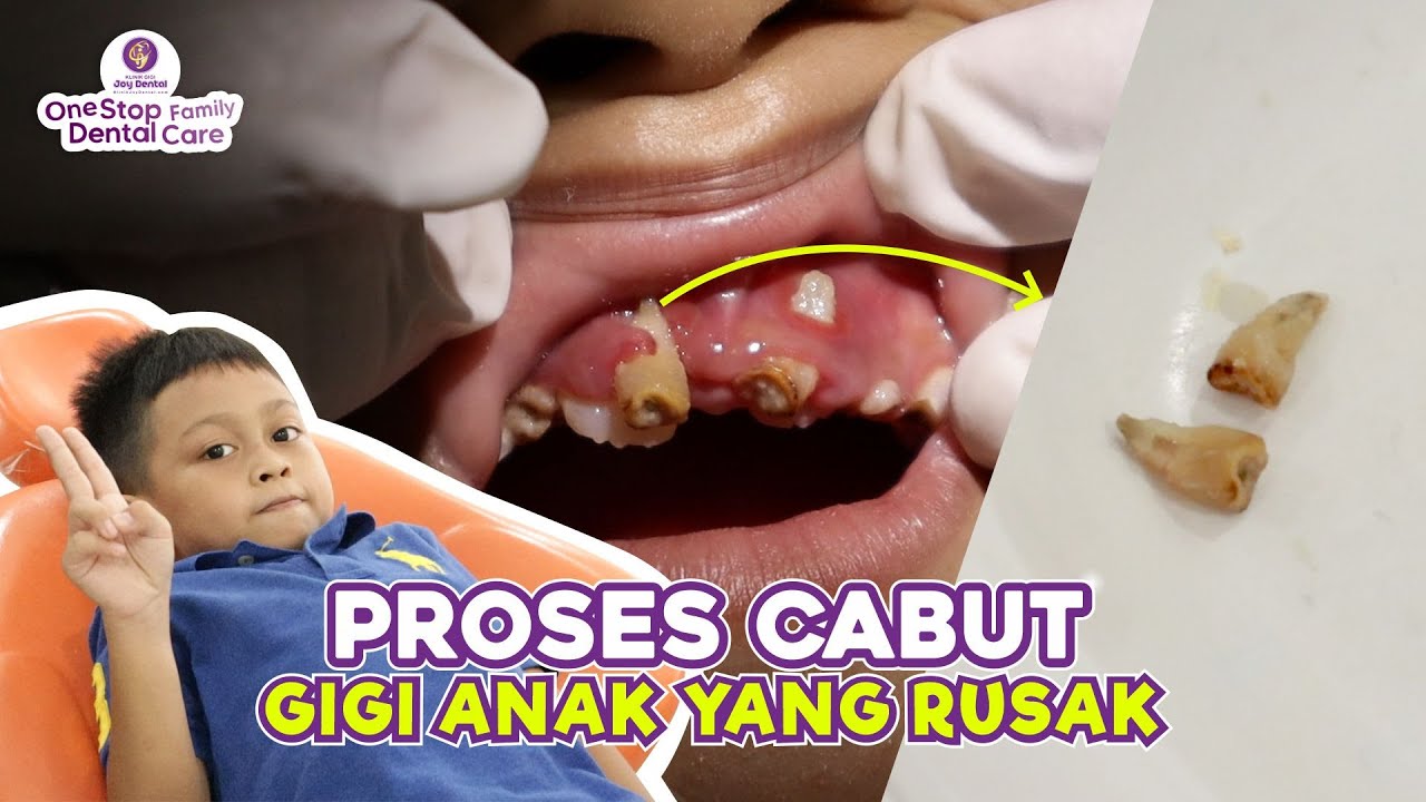 CABUT GIGI ANAK GAK PAKAI LAMA DI KLINIK GIGI JOY DENTAL - YouTube