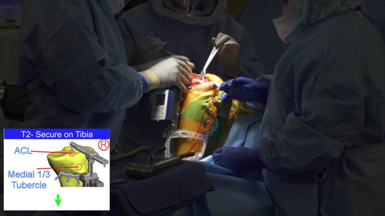 Dr. Bugbee using OrthAlign Knee Align - YouTube