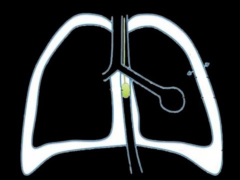 Transpulmonary Pressure Ptp ~ overview & Practical Application - YouTube