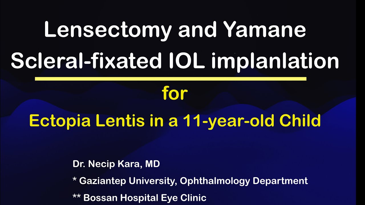 Lensectomy and Yamane Scleral-fixated IOL implantation. Dr. Necip Kara ...