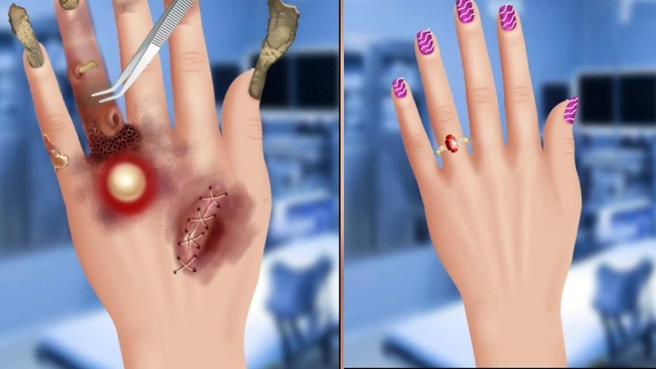 Watch This Animated Doctor Heal a Severe Wound Infection. - YouTube