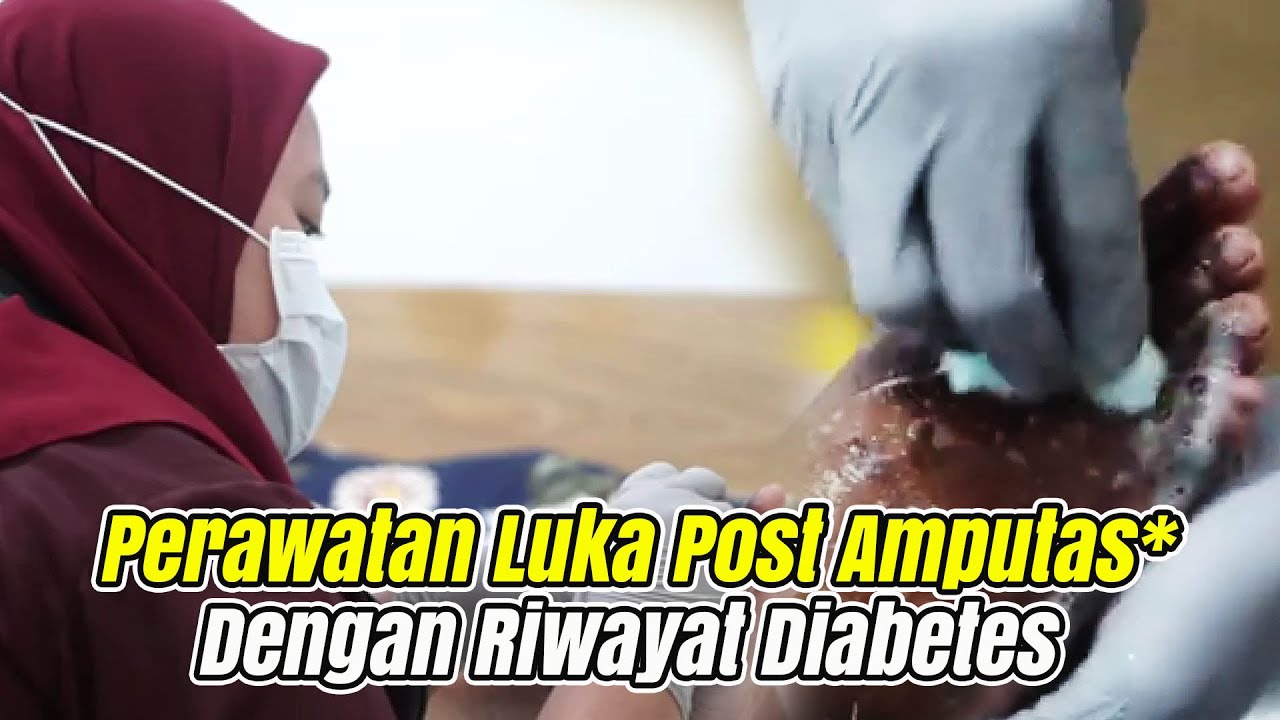 LUKA POST AMPUTAS* JEMPOL DENGAN RIWAYAT DIABETES - YouTube