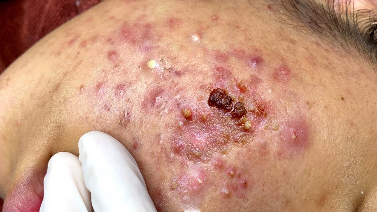 Big Cystic Acne Blackheads Extraction Blackheads & Milia, Whiteheads ...
