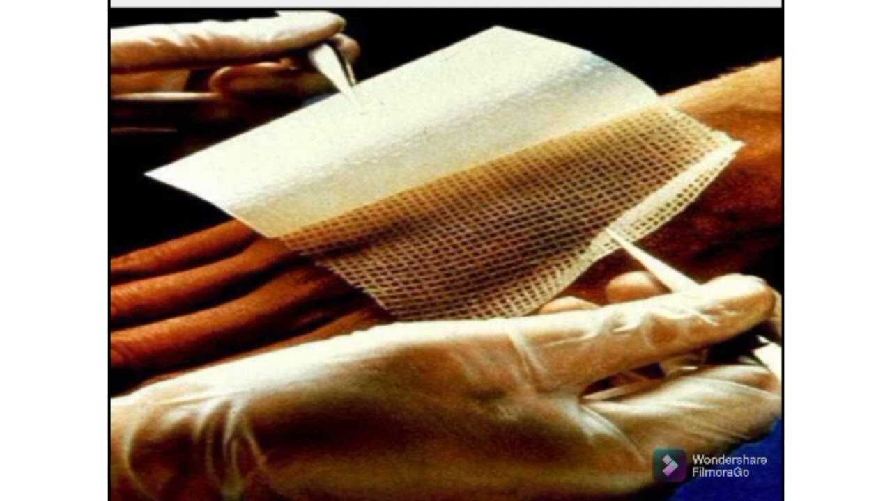 soins infirmiers en chirurgie:soins de plaies :pansement gras, points ...