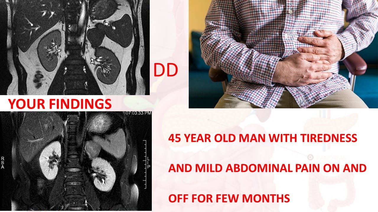 45 YEAR OLD MAN WITH TIREDNESS AND MILD ABDOMINAL PAIN ON AND OFF FOR ...