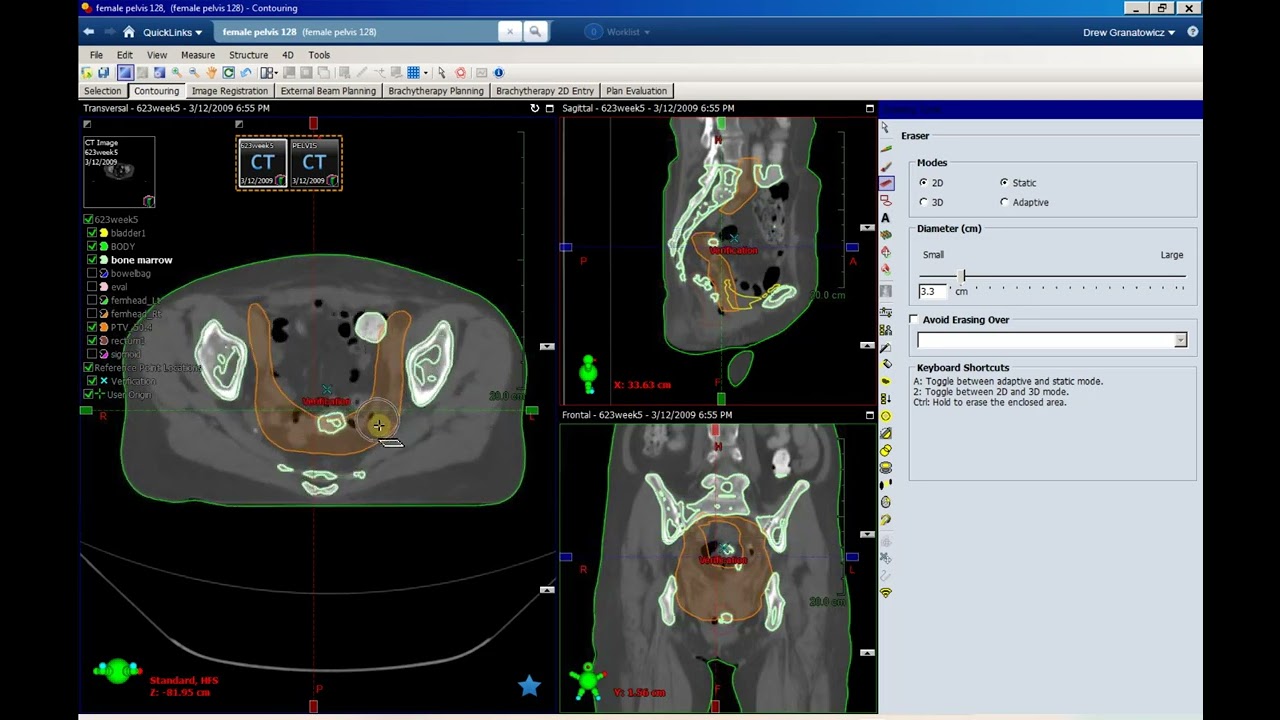 Contouring Bone Marrow - YouTube