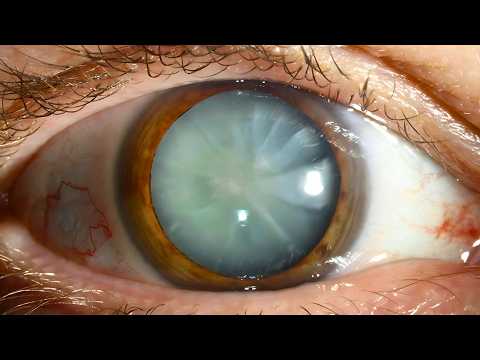 What Do Blind People See?