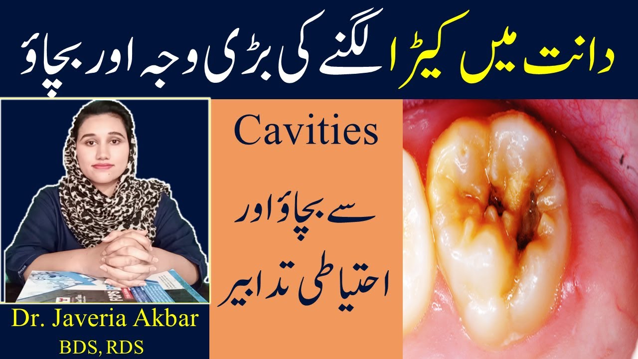Tooth Caries Prevention, Tooth Decay Prevention, Tooth cavities ...
