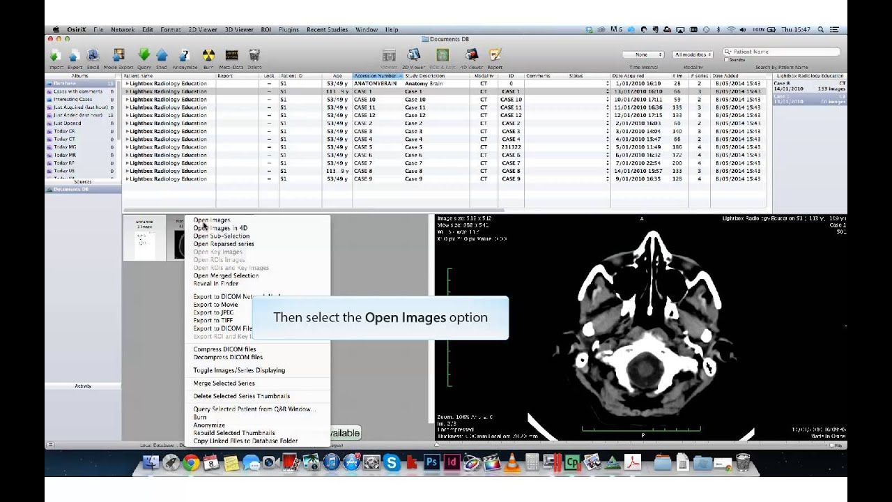 How to Use OsiriX - YouTube