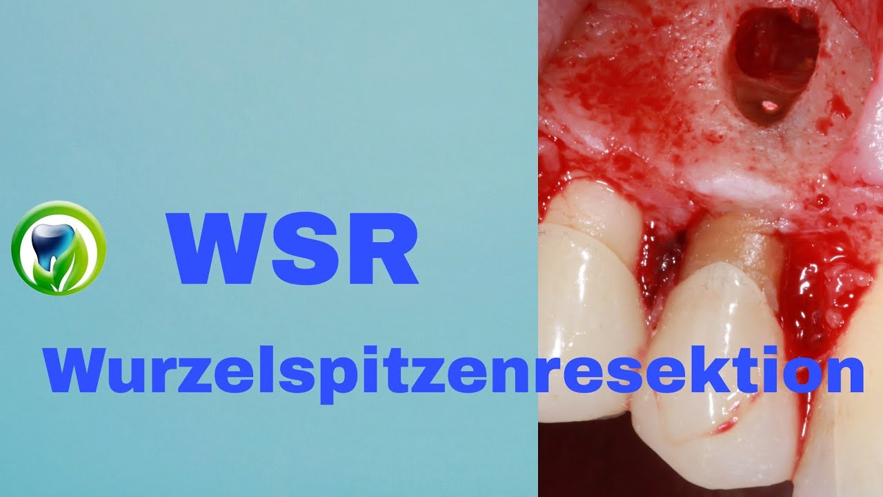 Die Wurzelspitzenresektion / WSR - retrograde Wurzelfüllung ...