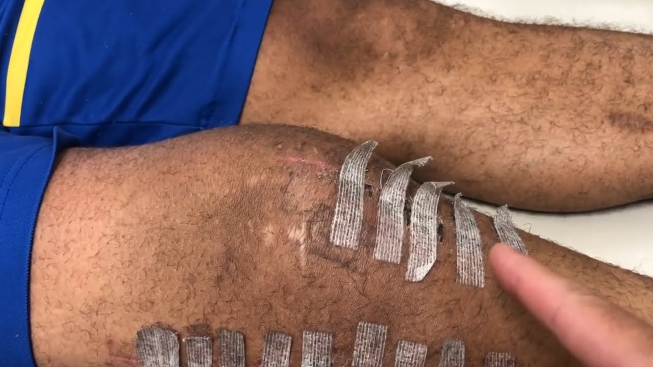 ACL Reconstruction & Post Surgical Steri Strips 🔴 LIVE #ClinicCAM - YouTube