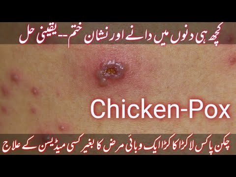 What Is Chicken Pox? Cause, Symptoms and Treatment | Lakra Kakra ka ...