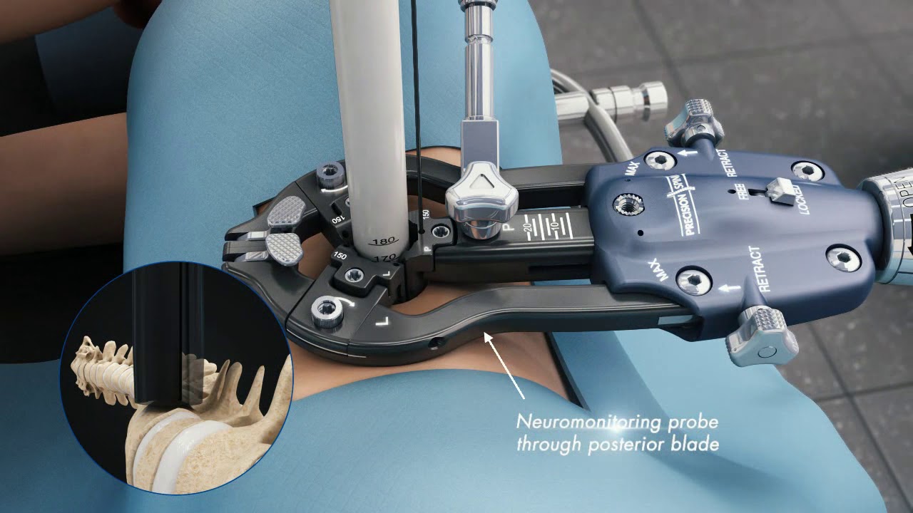 Precision Spine® MD-Vue™ Lateral Access System - YouTube