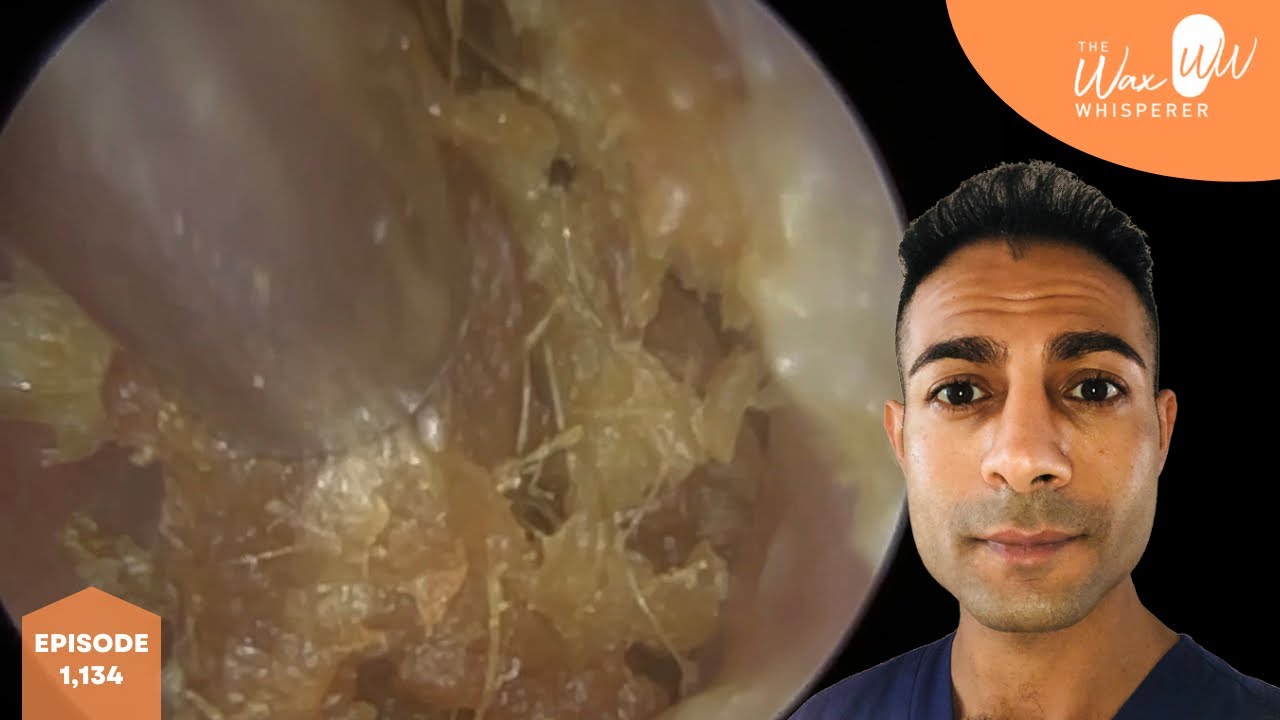 1,134 - Extremely Blocked Dry Ear Wax & Dry Skin Plugs - YouTube