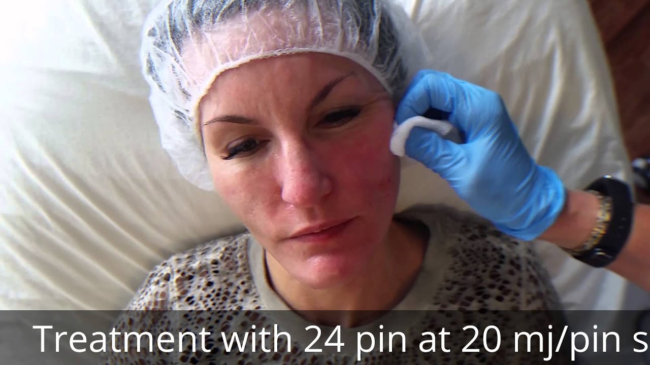 Fractora by Inmode - YouTube