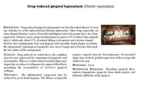 drug induced gingival hyperplasia - YouTube