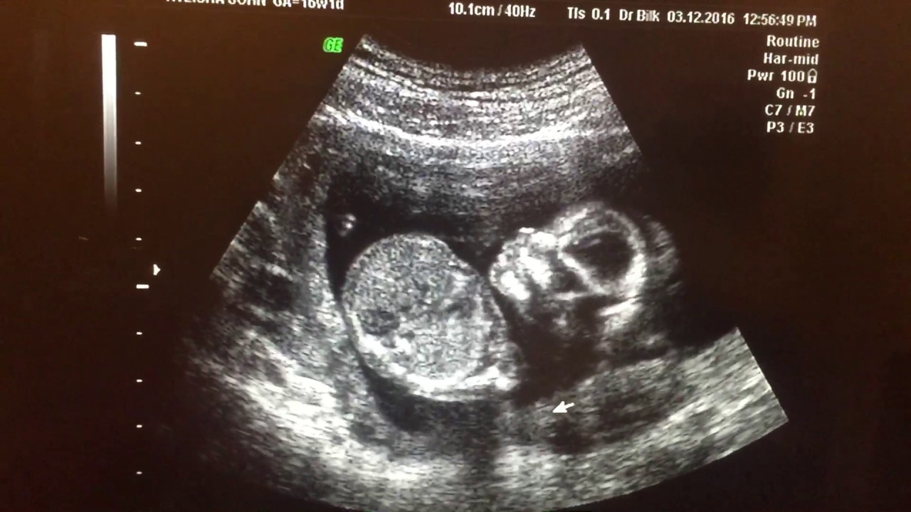16 weeks and 1 day gender scan... It's a girl!!! - YouTube