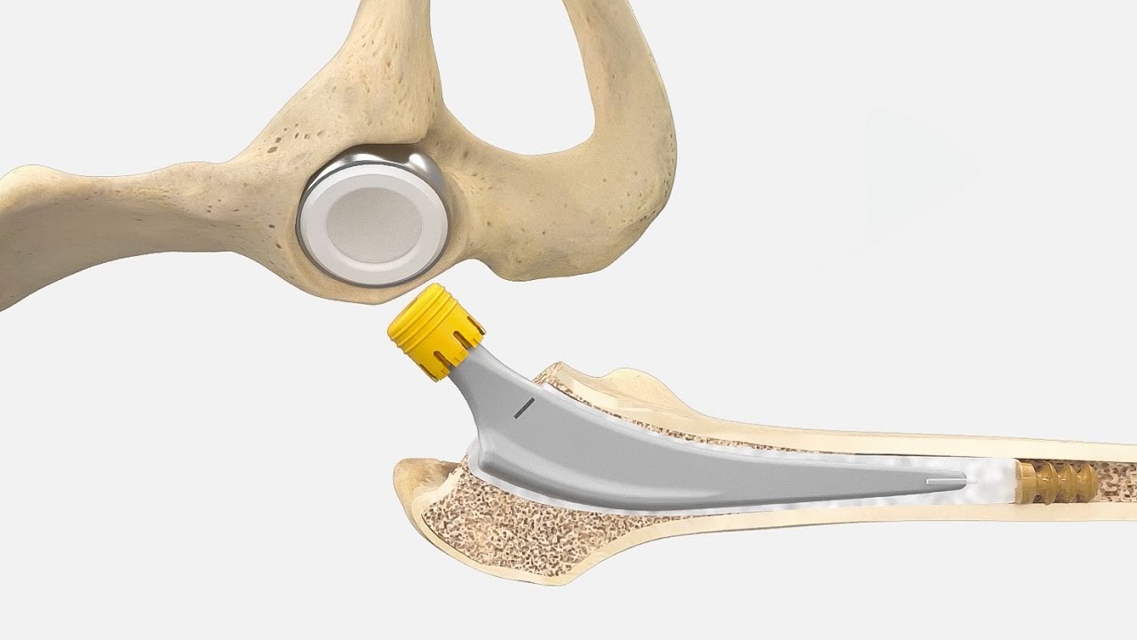 Aesculap® Bipolar Cup & Excia® T Cemented - YouTube