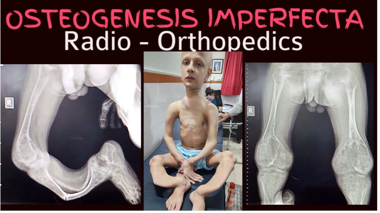 Osteogenesis Imperfecta CASE 1/Video 2/ Radio-Orthopedic presentation ...