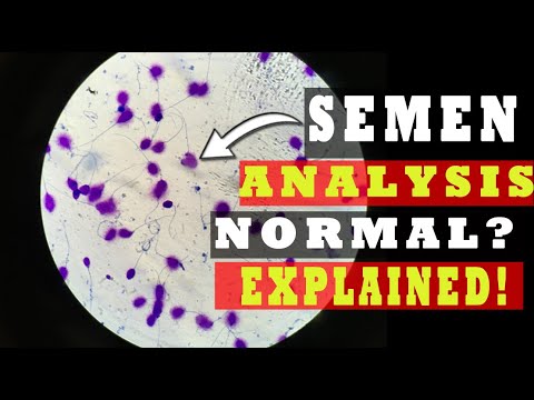 What is Semen Analysis Test | Procedure, Normal & Abnormal Report ...