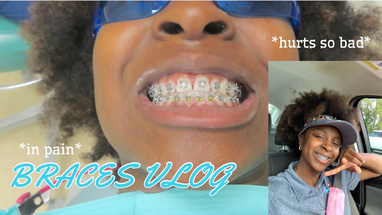 Vlog: Come with me to get BRACES! #braces #recommend - YouTube