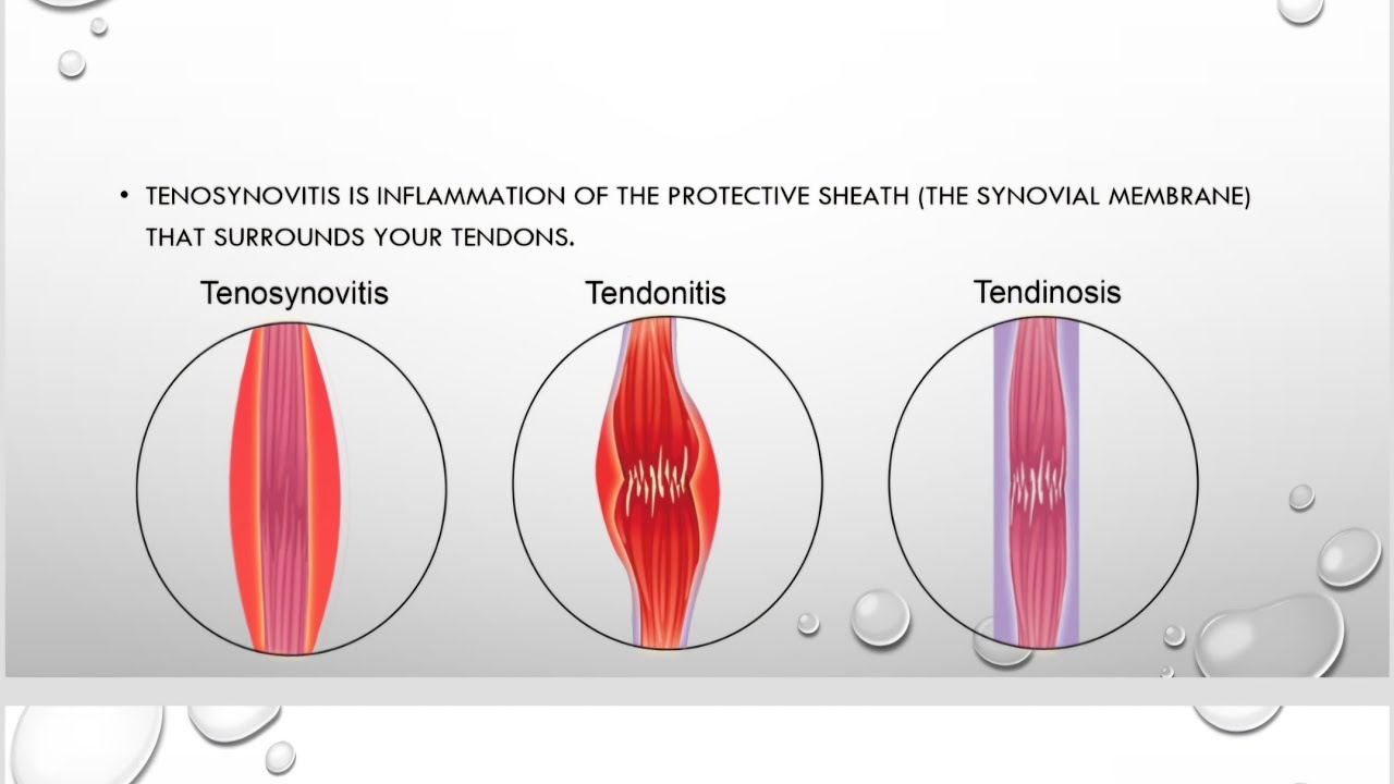 Tendinopathy Rehabilitation ||Tendonitis|| Tendinopathy ||Tendinosis ...