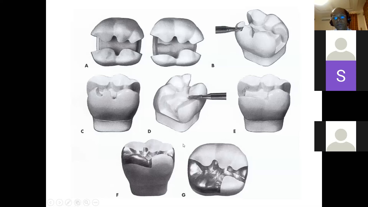 Complex Amalgam Restorations - YouTube