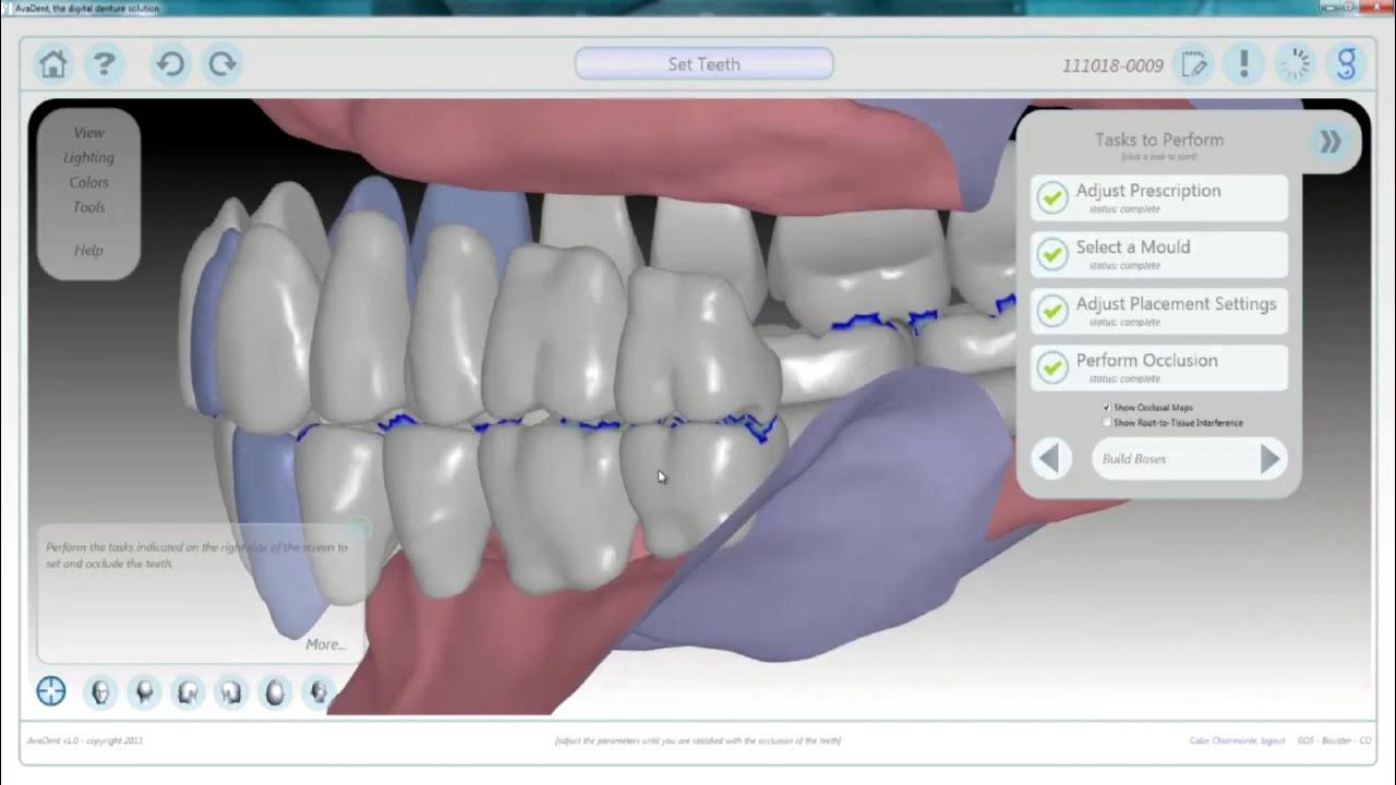 AvaDent digital dentures: Laboratory fabrication process - YouTube