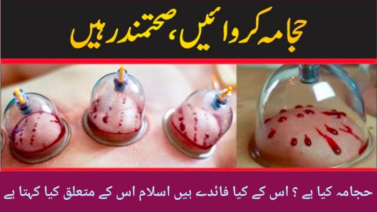 What is the Hijama | Benefits of Hijama Cupping therapy | Hafiz Arshad ...