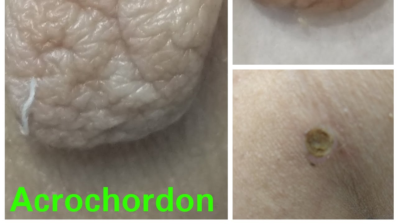 #skintags #skintag #acrochordon #skintagremoval - YouTube