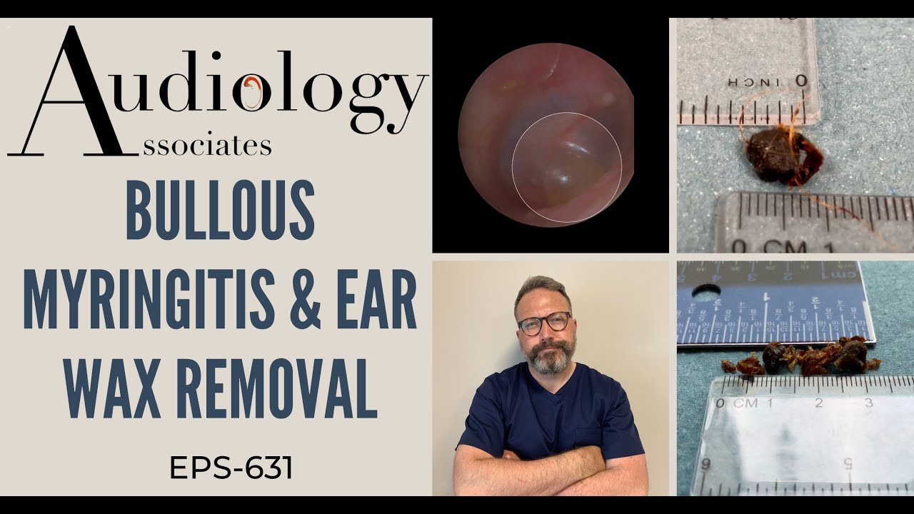 BULLOUS MYRINGITIS & EARWAX REMOVAL - EP631 - YouTube