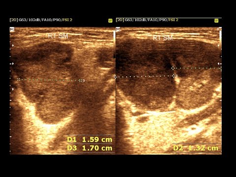 Right sided Submandibular and posterior auricular lymphadenopathy ...
