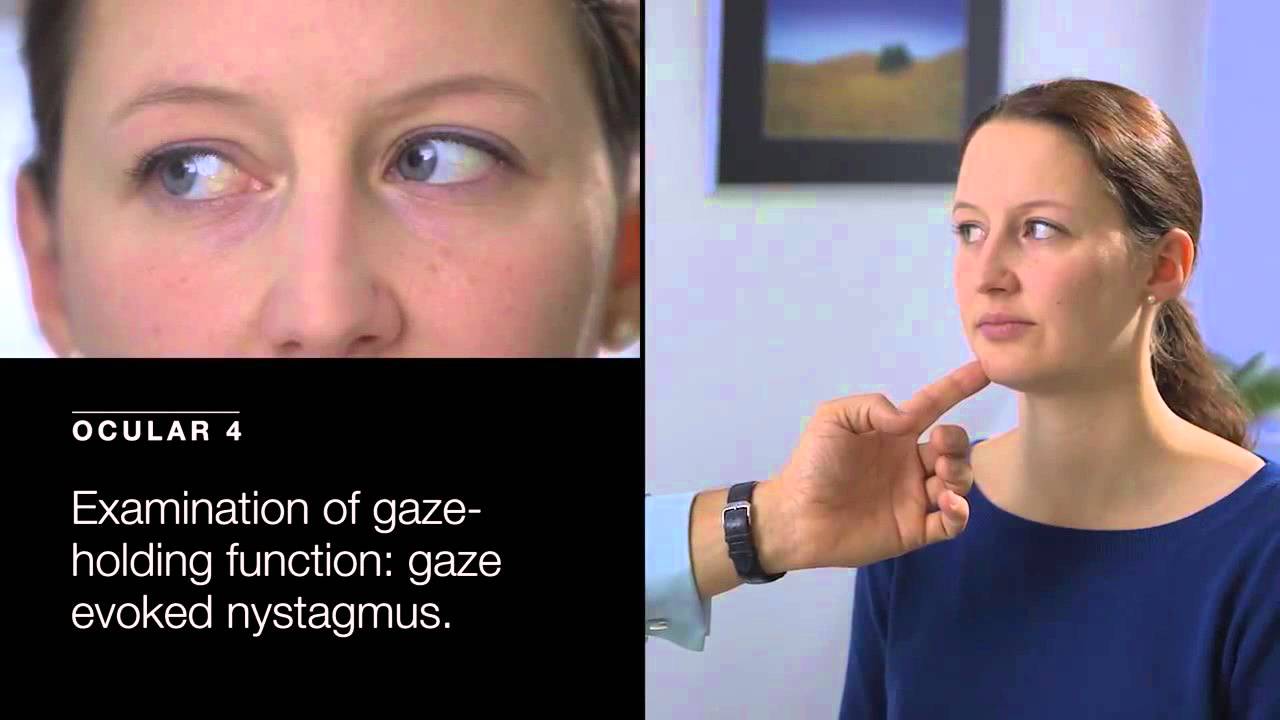 Examination of Gaze Holding Deficit Gaze Evoked Nystagmus - YouTube
