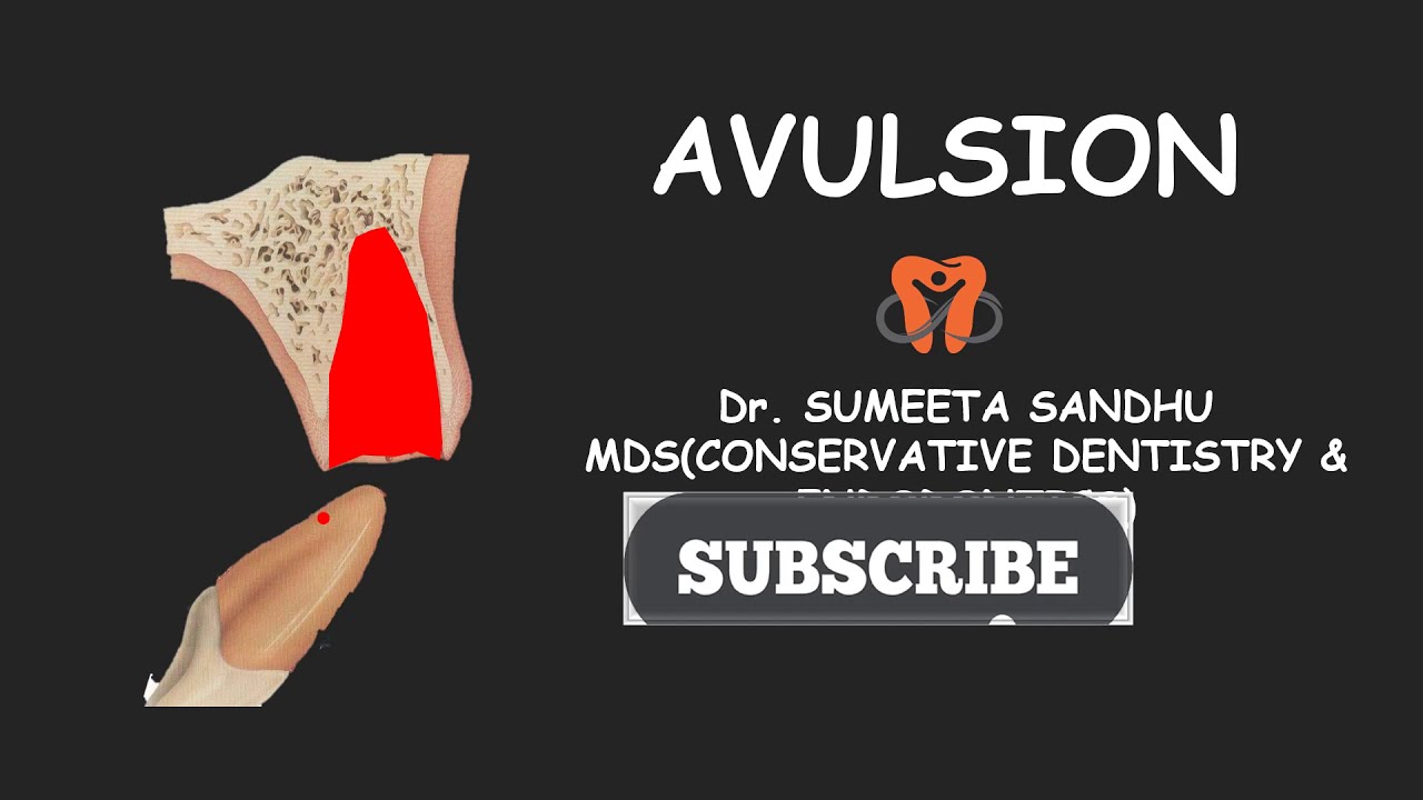 Dental Avulsion