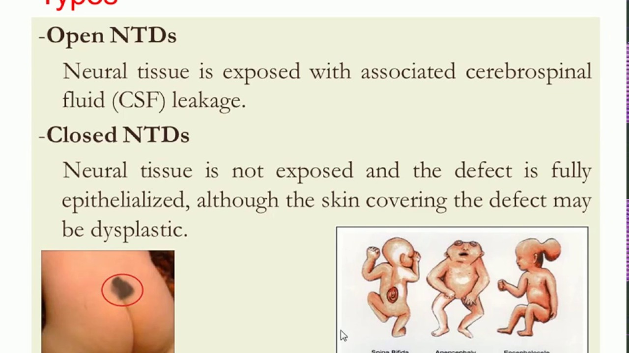 Neural Tube Defect YouTube neural-tube-defect-youtube
