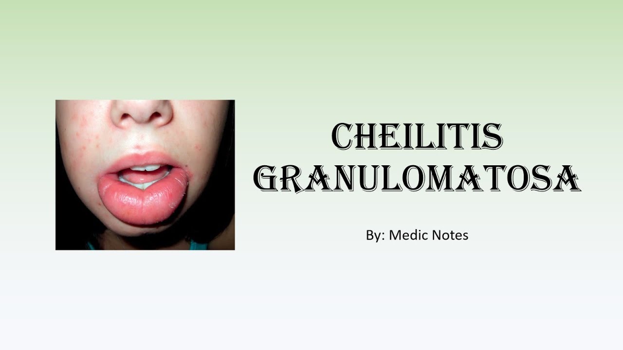 Cheilitis granulomatosa - causes, signs & symptoms, investigation ...