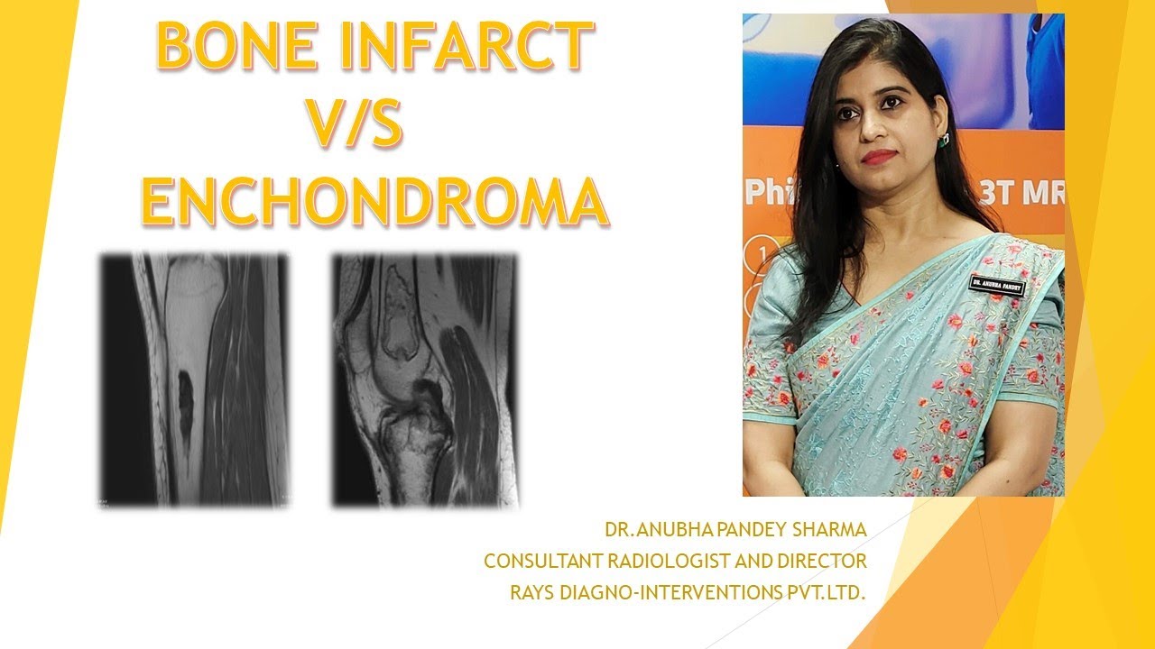 BONE INFARCT V/S ENCHONDROMA - YouTube