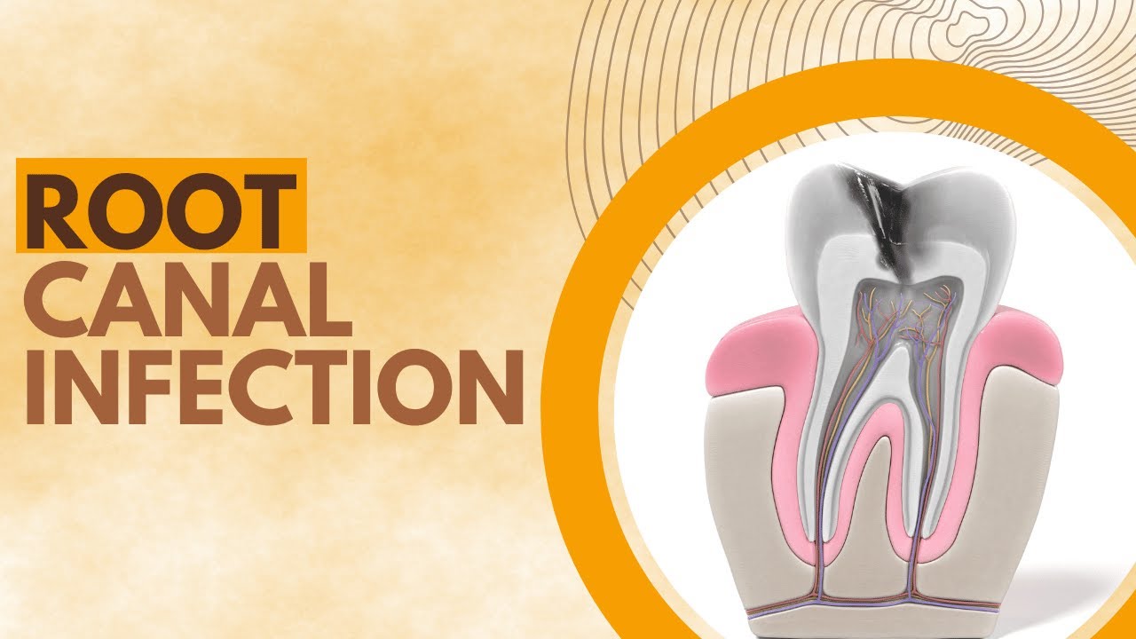 Root Canal Infection: Understanding and Managing the Pain - YouTube