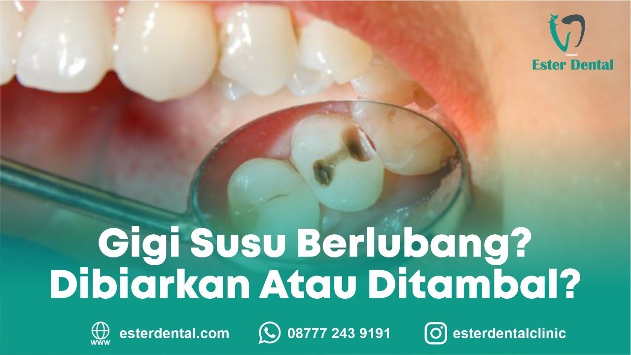 Gigi Susu Yang Berlubang Harus Dibiarkan Atau Ditambal? - YouTube