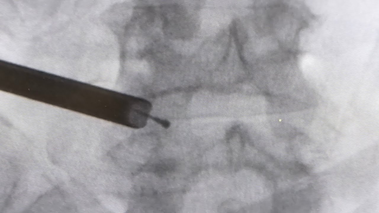 Posterior oblique approach - YouTube