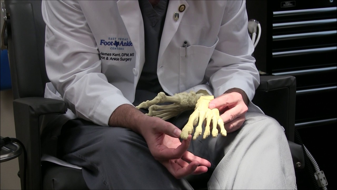 Silver Bunion Surgery Explained - YouTube