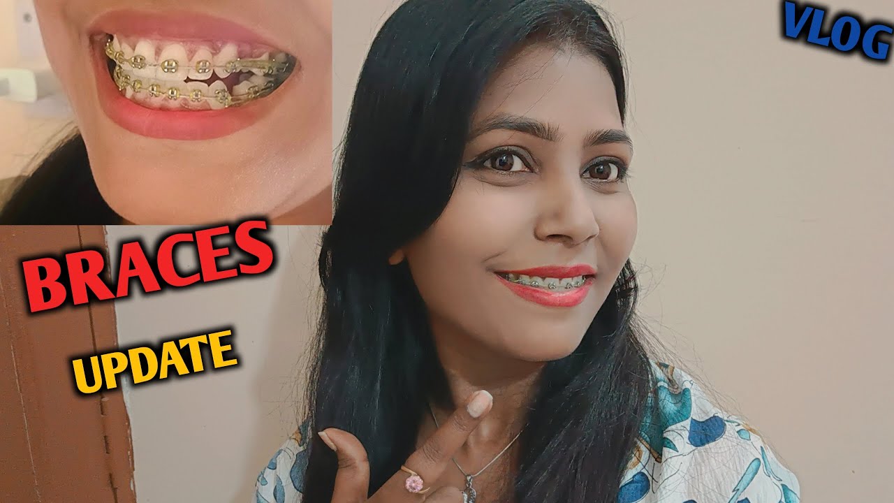My Braces Journey 😊 || Braces Update/ Nd Family Vlogs - YouTube