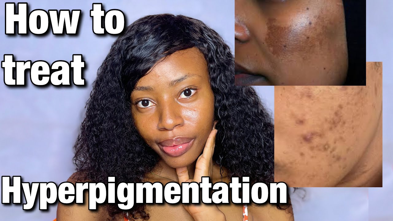 How to clear hyperpigmentation | Tips to get rid of and treat dark ...