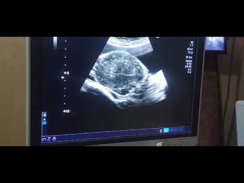 Adenomyosis And Chocolate cyst in Left ovary - Bulky uterus in ...