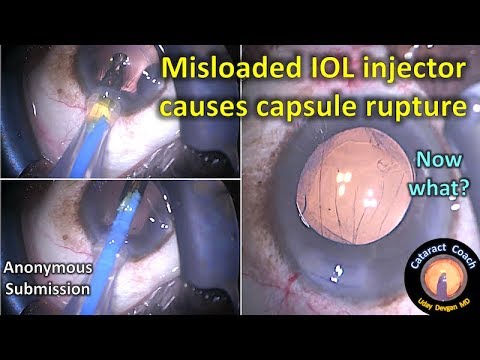 How to fix: Misloaded IOL rips open the posterior capsule in Cataract ...