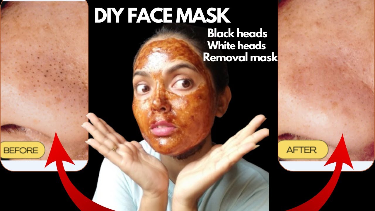 DIY face mask for blackheads and whiteheads. ब्ल्याकहेड्स र ...